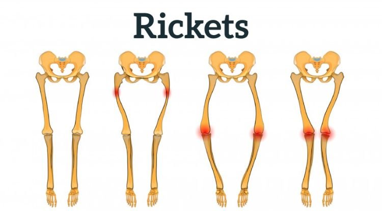 Rickets In Adults