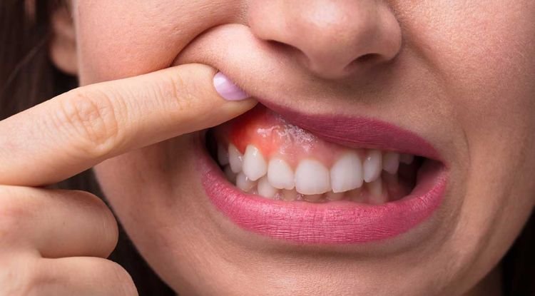 Oral Cancer Symptoms Cnc Health Info
